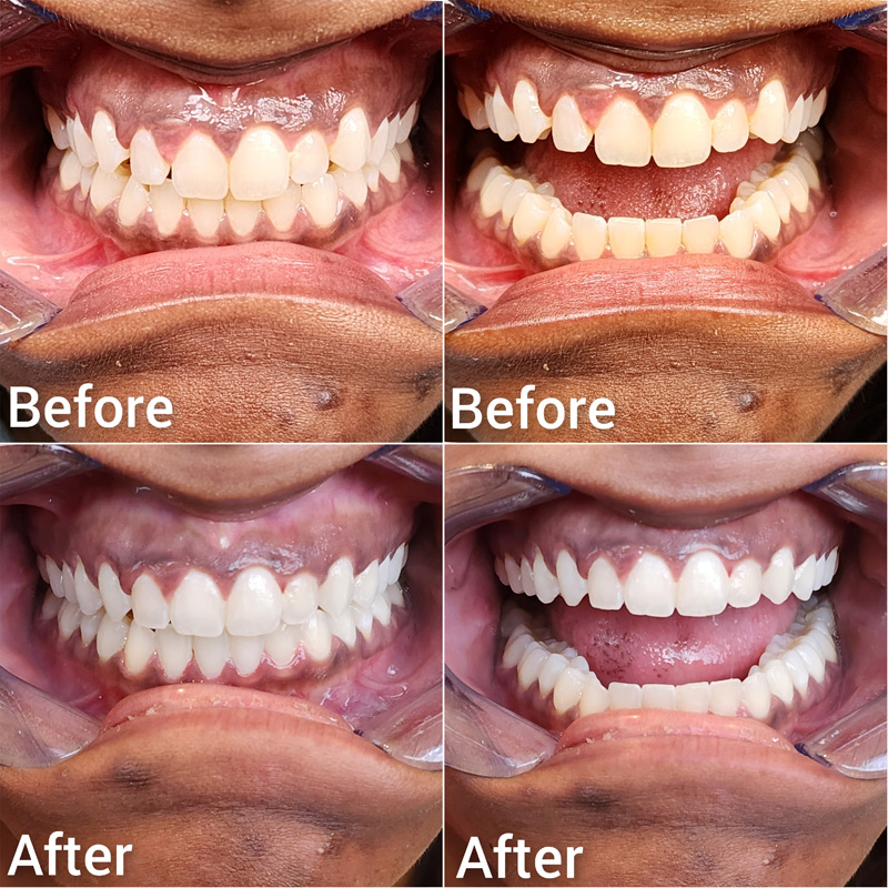 Invisalign in Fishers, IN - Invisalign Treatment in 46037